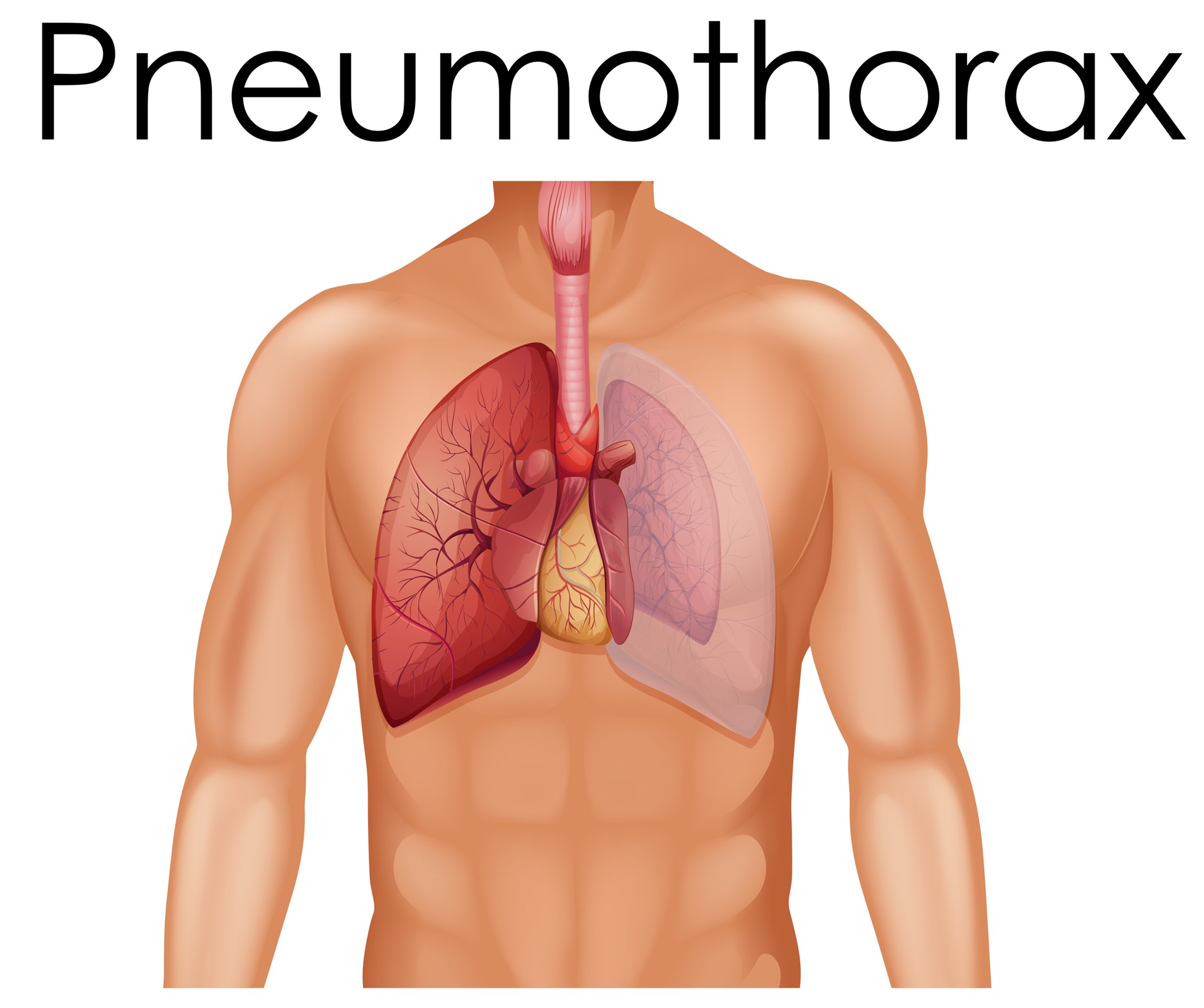 Understanding Pneumothorax: Symptoms, Causes, and Treatment - Dr. R. Anand