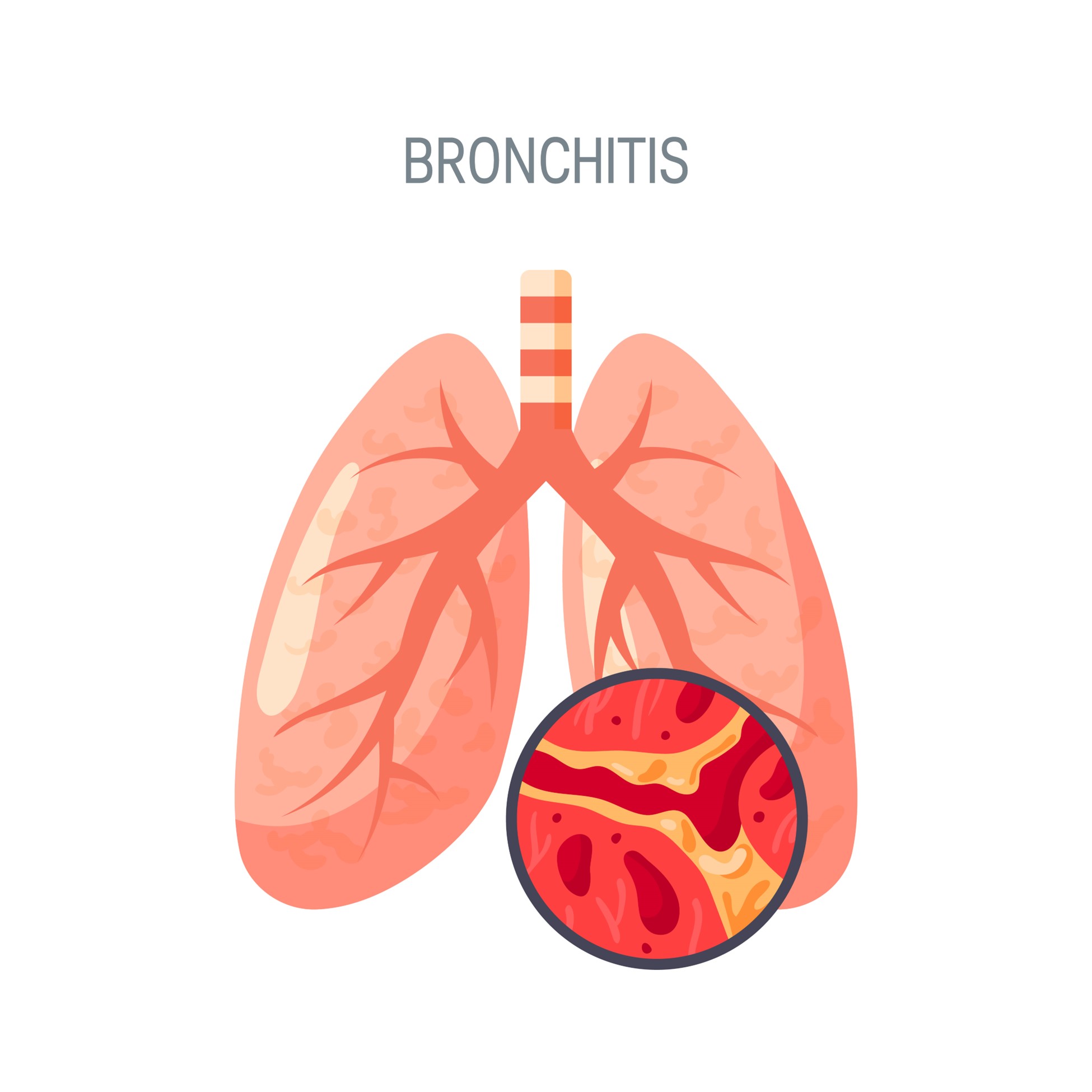 Acute Bronchitis vs Chronic Bronchitis: What You Need to Know - Dr. R ...